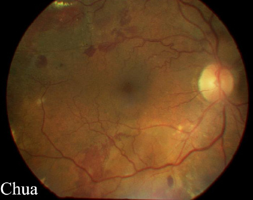 Atlas of posterior segment: syphilitic chorioretinopathy